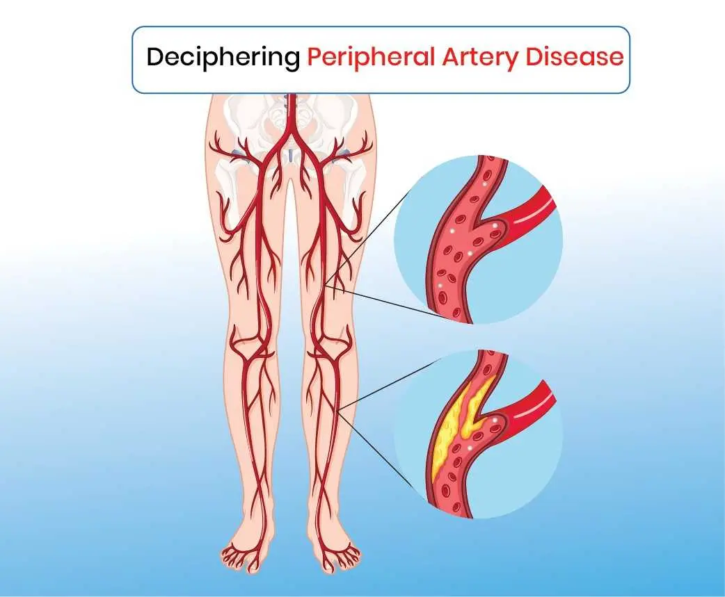 Peripheral Artery Disease: Symptoms, Causes & Treatment