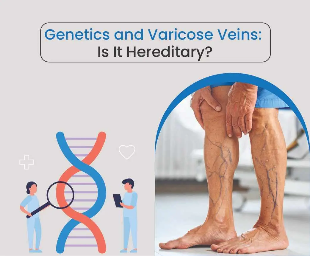 Are Varicose Veins Hereditary? Genetics & Risk Factors