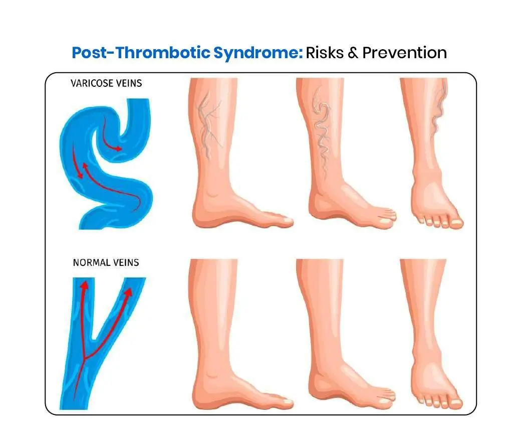 Vascular Disease Symptoms & Treatment | Avis Vascular Center