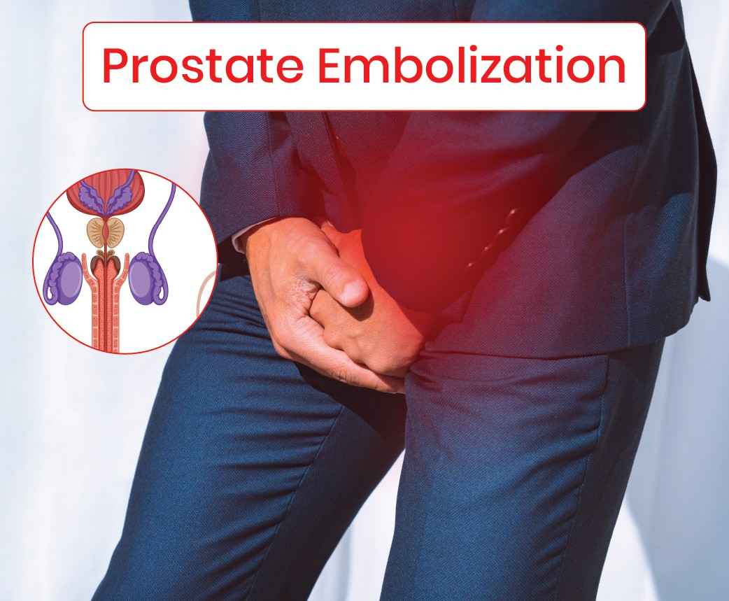 Prostate Artery Embolization | Non-Surgical Prostate Treatment