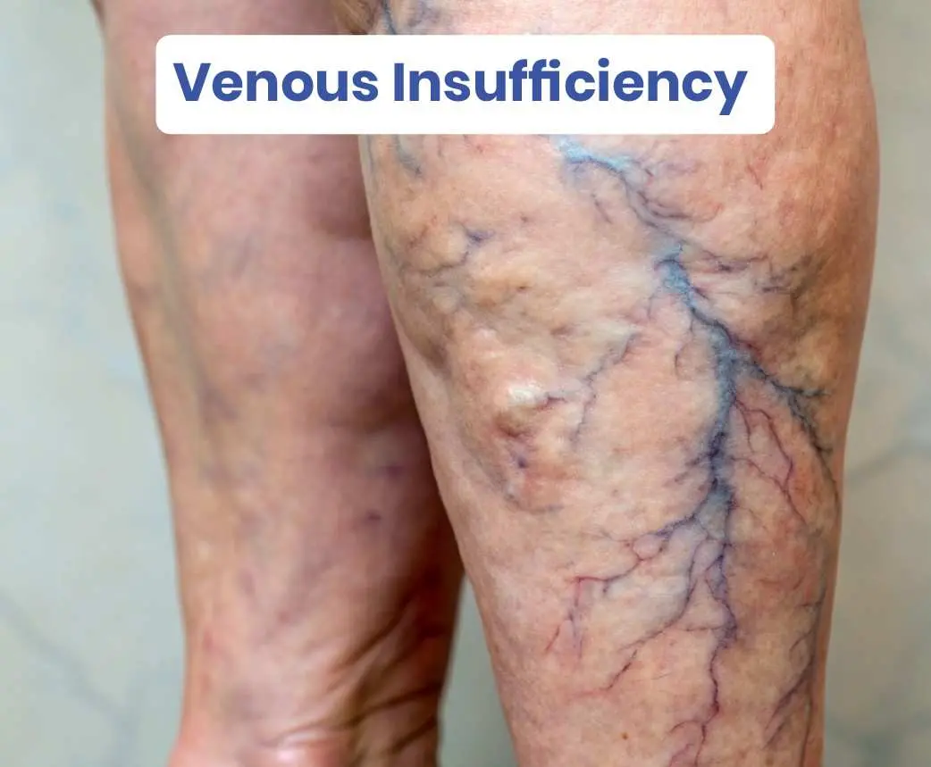 Venous Insufficiency: Symptoms, Causes & Treatment