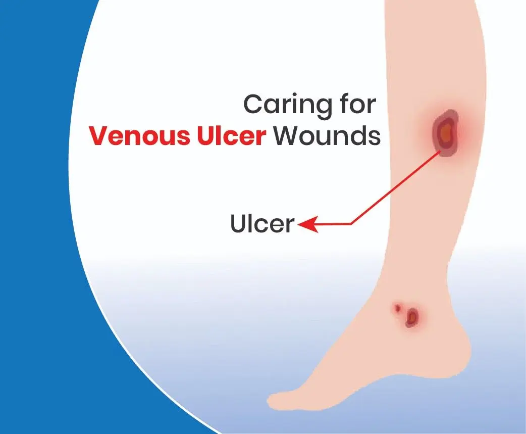 Venous Ulcer Care: Treatment & Wound Management