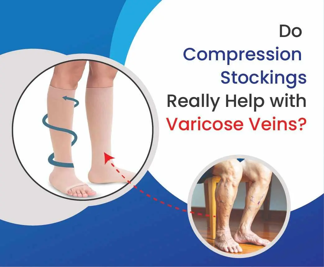 Do Compression Stockings Help with Varicose Veins?
