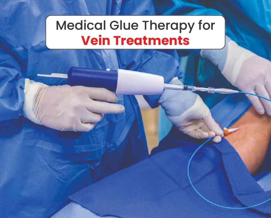 Medical Glue Treatment for Varicose Veins | Vein Glue Therapy