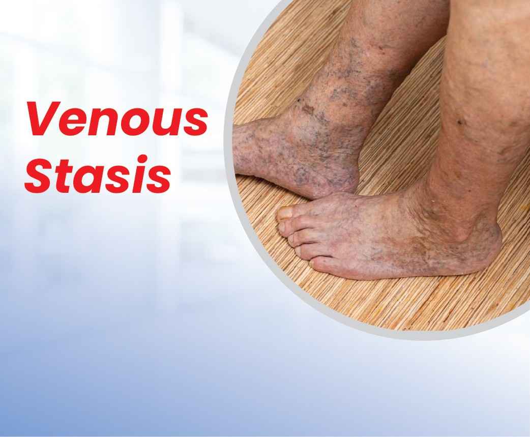 Blog | Venous Stasis: Causes, Symptoms & Treatment Options