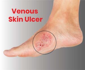 Leg Ulcers - Types of Ulcers, Their Causes, Treatment Options and Means ...
